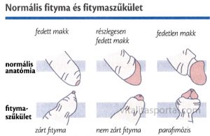 Spanyolgallér: a fitymaszűkület komplikációja